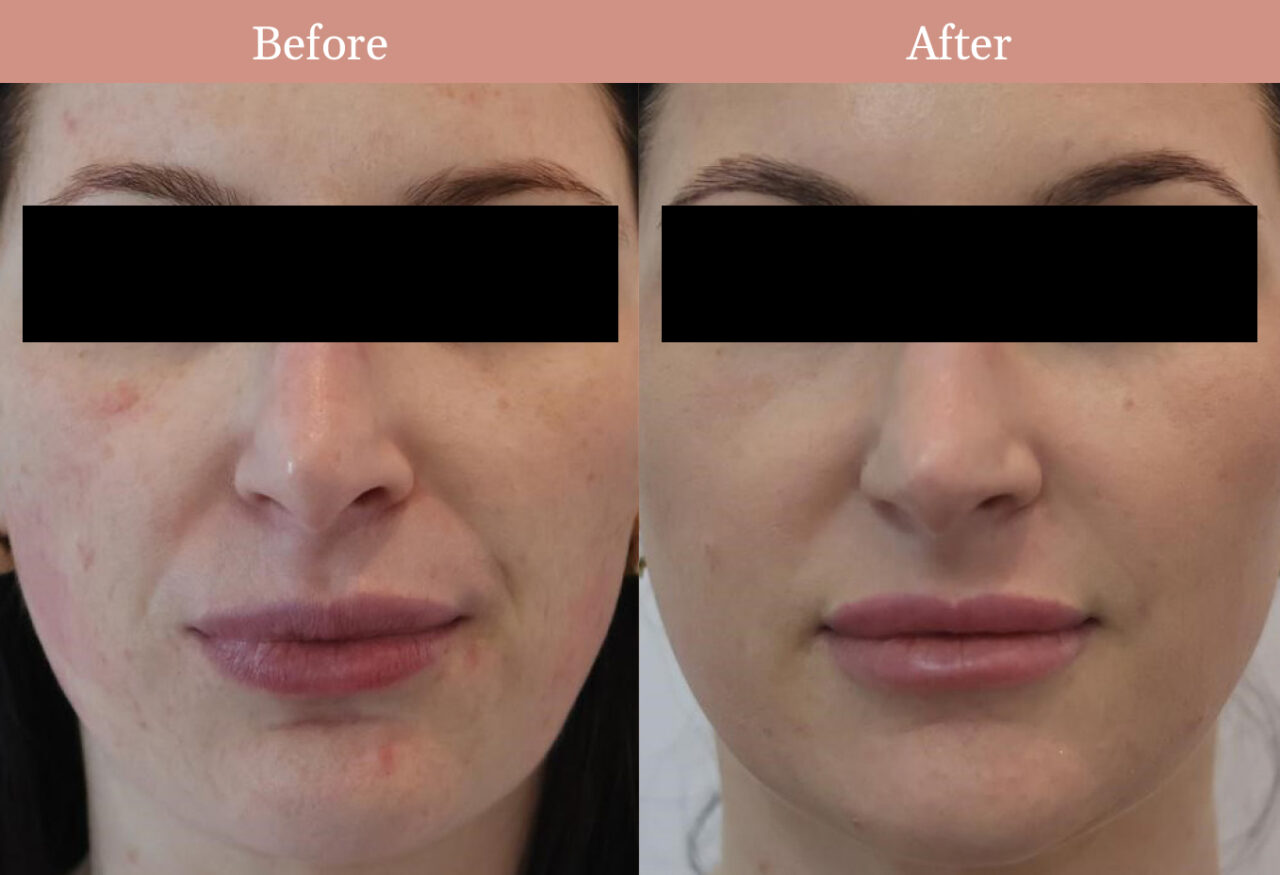 AuraLux Aesthetic Laser | Total skin health solutions