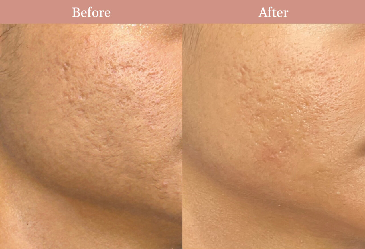 AuraLux Aesthetic Laser | Total skin health solutions